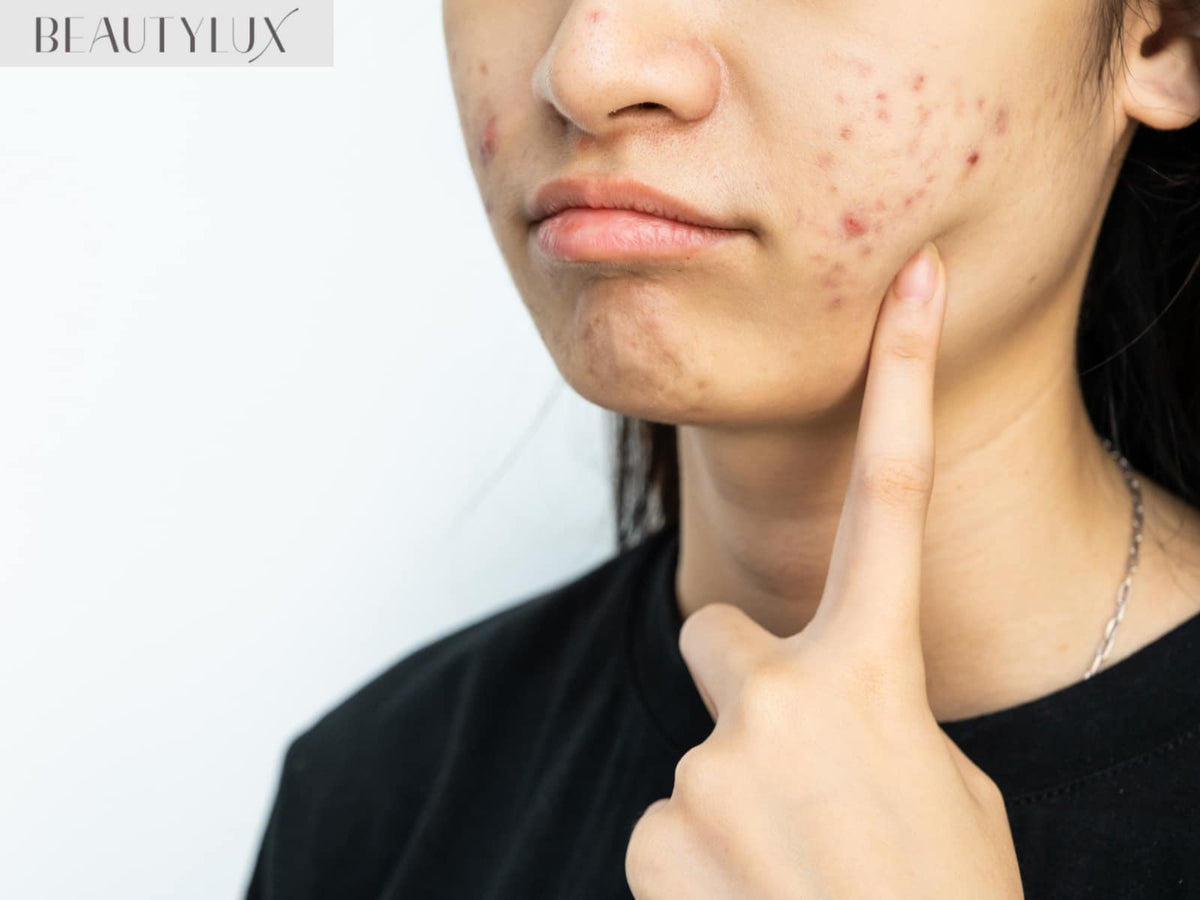 The Best Ingredients for Acne-Prone Skin